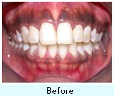Gum Depigmentation Treatment in South Delhi - 32 Strong